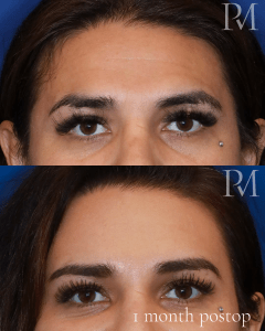 Facial Feminization Surgery Los Angeles - FFS LA