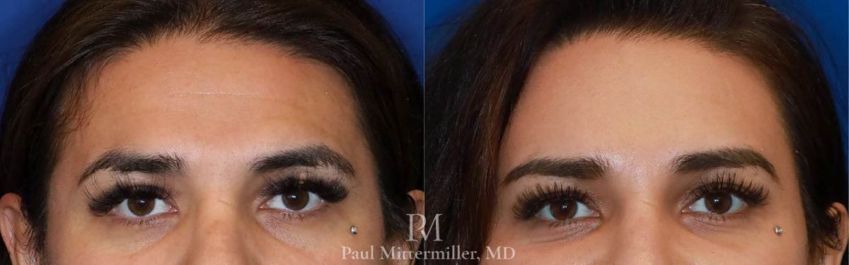 Type 3 Brow Bone Setback Before and After Photos - #220727