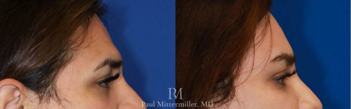 Type 3 Brow Bone Setback Before and After Photos - #220727