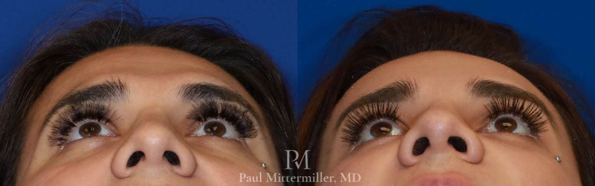 Type 3 Brow Bone Setback Before and After Photos - #220727