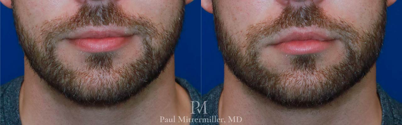 Facial Masculinization with Filler Before and After Photos - 220830 ...