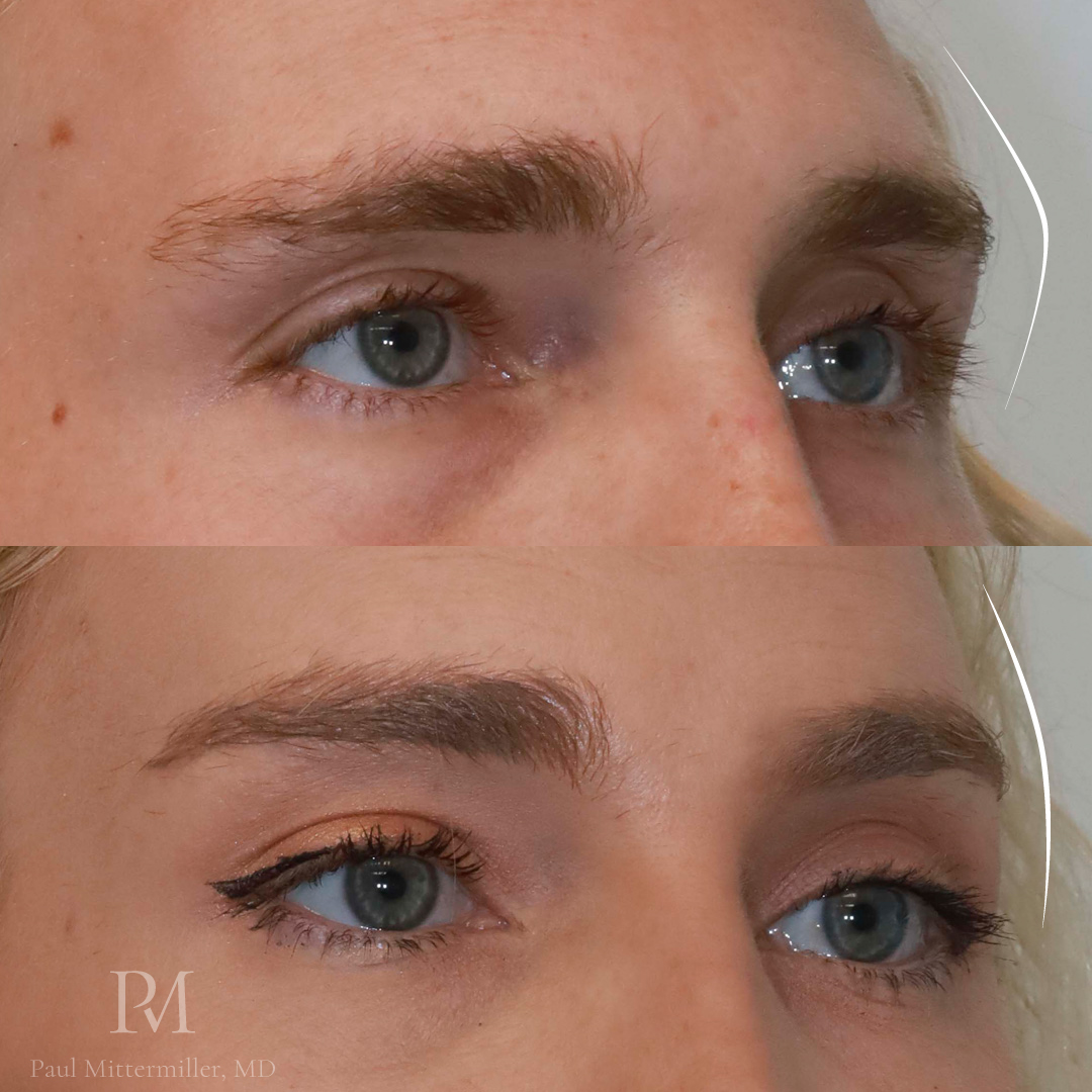 Before and After - #221206 - Paul Mittermiller, MD