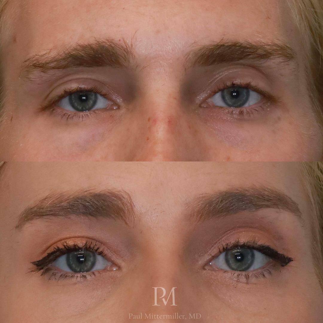 Before and After - #221206 - Paul Mittermiller, MD