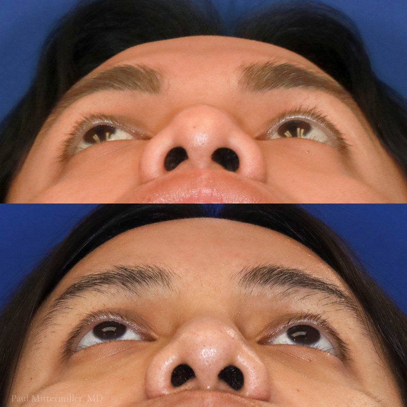 Type 3 Brow Bone Reduction Before After Photos - #230407 - Paul ...