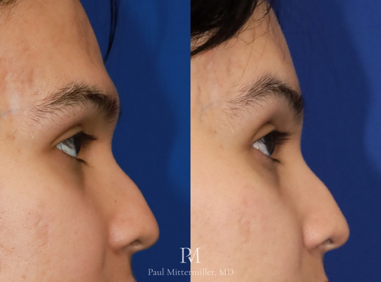 Facial Feminization Surgery Photo Gallery - Paul Mittermiller, MD