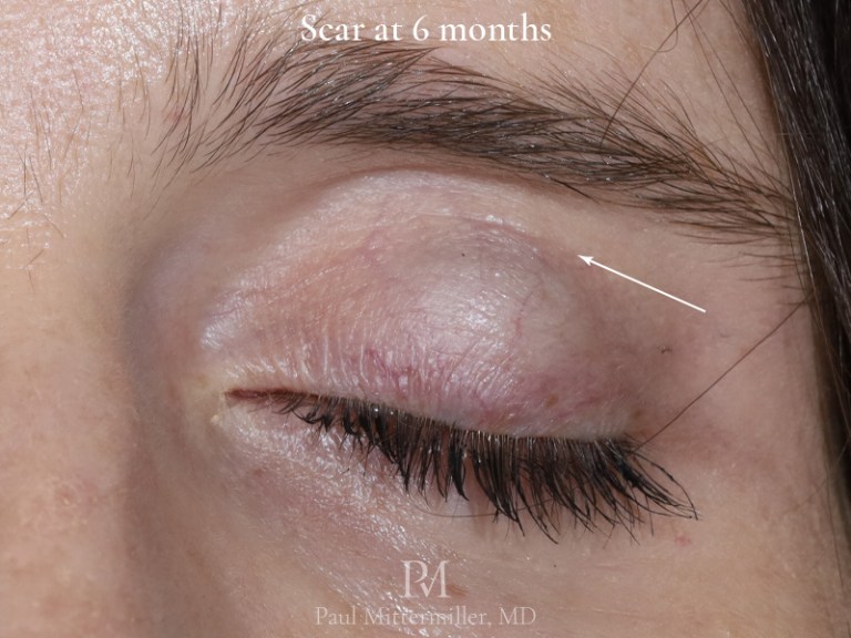 Orbital Rim Contouring Through Upper Eyelid Incision - #221123 - Paul ...