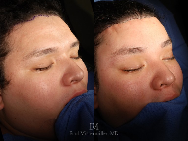 Type 1 Brow Bone - Before and After - #230822 - Paul Mittermiller, MD