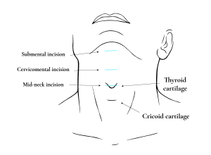 Tracheal Shave - Adam's Apple Reduction