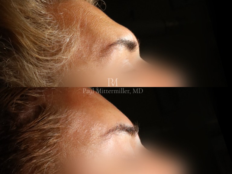 Facial Feminization Surgery Photo Gallery - Paul Mittermiller, MD