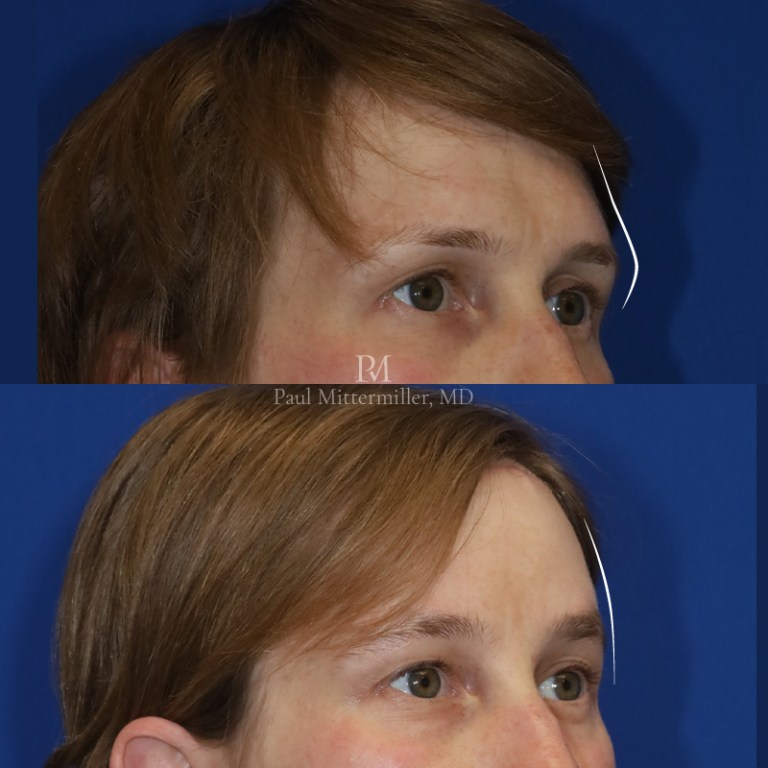 Facial Feminization Surgery Photo Gallery - Paul Mittermiller, MD