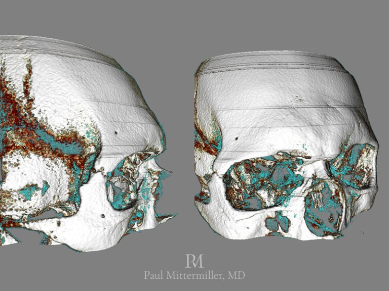 Type 3 Brow Bone Reduction with Ethmoid Lesion - Before and After ...