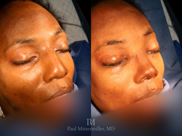 Type 3 Brow Bone Reduction and Reduction Rhinoplasty - Before and After ...