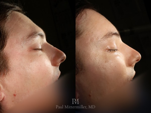 Type 3 Brow Bone Reduction - Before and After - #231206 - Paul ...