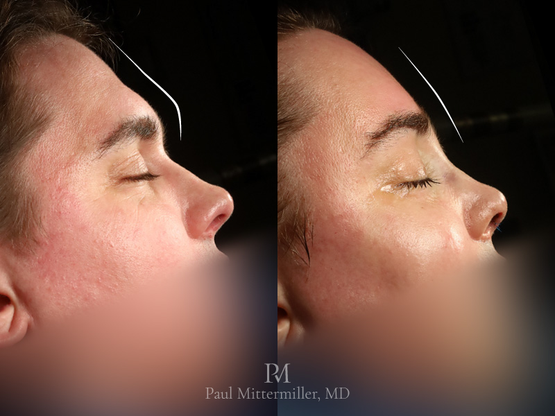 Brow bone reduction, orbital contouring - Before and After - #231213 ...