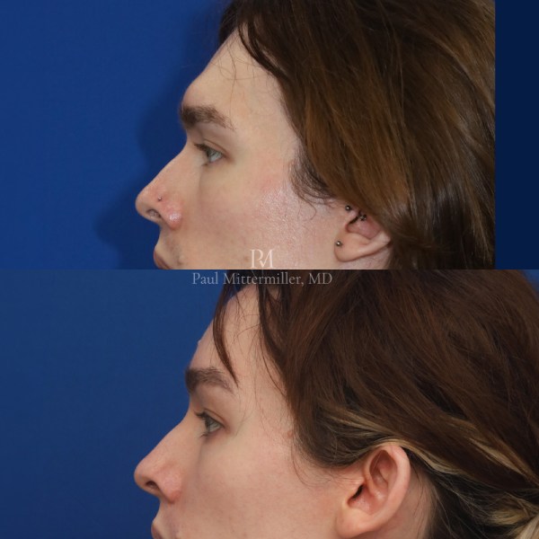 Facial Feminization Surgery Photo Gallery - Paul Mittermiller, MD