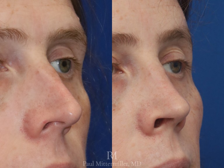 Facial Feminization Surgery Photo Gallery - Paul Mittermiller, MD